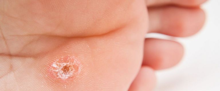 Fjerne vorte (utvekst) i Sandefjord