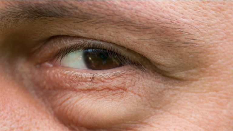 Chalazion | HelseSmart