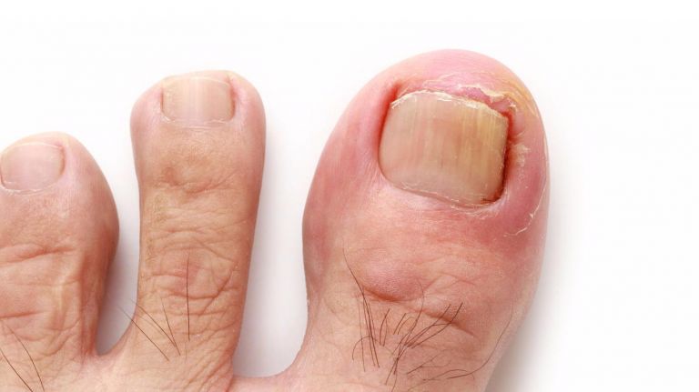 Småkirurgi, inngrodd negl en/to sider hos Anker plastikkirurgi